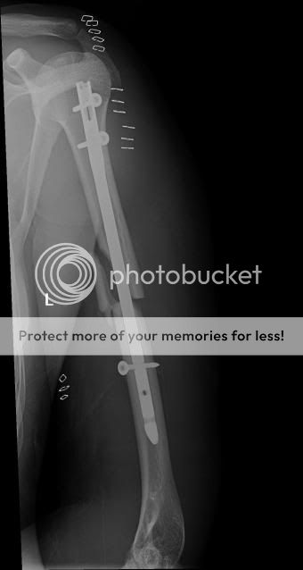 humerus breuk in bovenarm ervaringen? • Bokt.nl